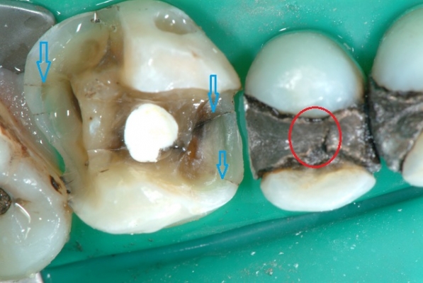 Brittany Lamoureux, DMD | Should I Replace Silver Fillings?